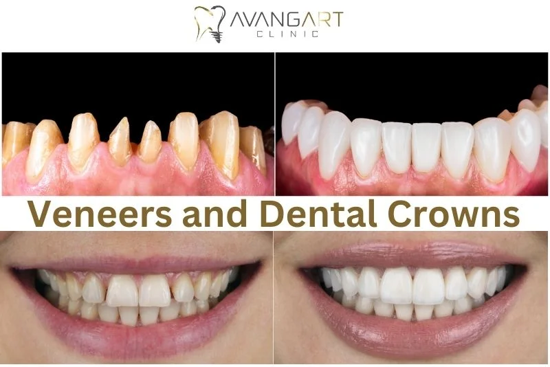 Dental Crowns Turkey | Porcelain, Zirconia & E-max Cost