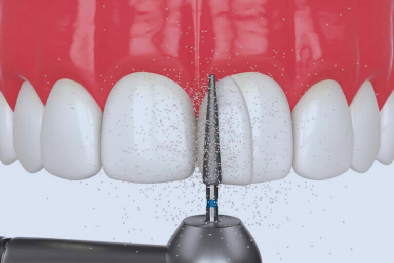 What is Composite Bonding & What to Expect?