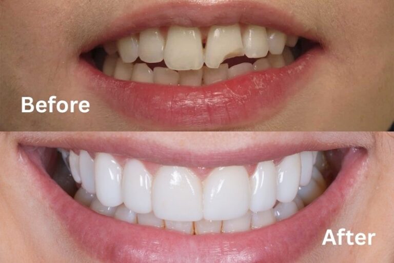 What is Composite Bonding & What to Expect?