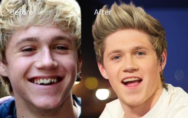 Niall Horan's Teeth - Before & After Transformation