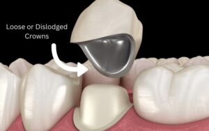 7 Common dental crown problems and How to fix them affordably