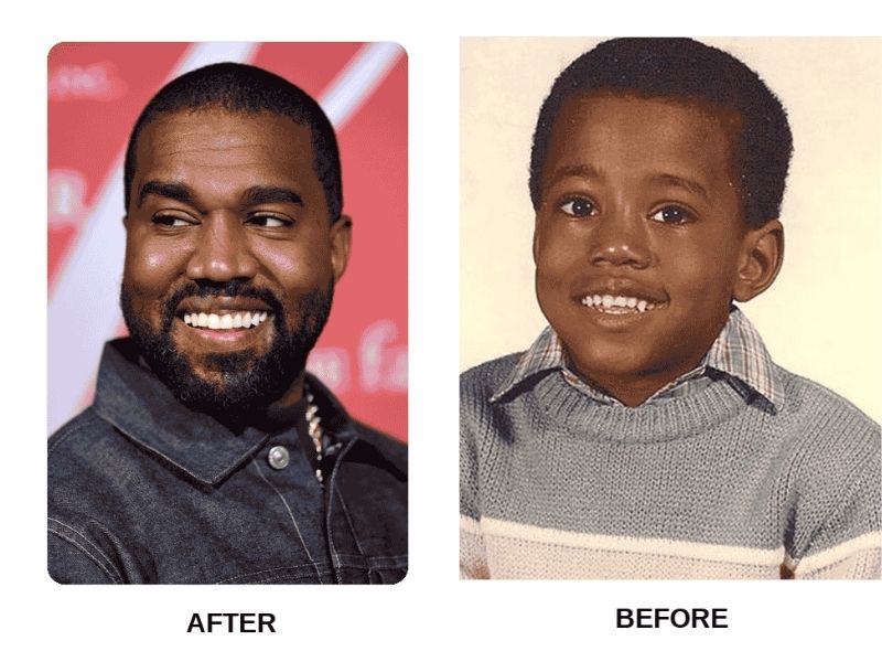 Kanye West New Teeth Worth $850K Titanium Dentures