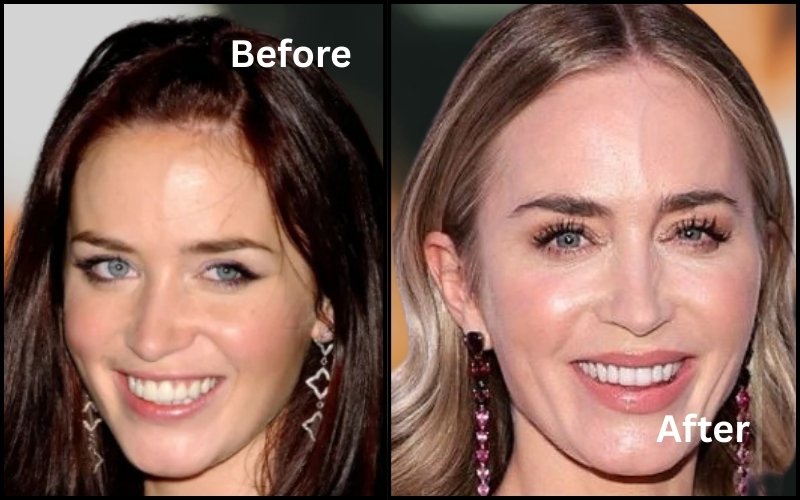 Zac Efron Veneers – Smile Transformation, Before & After
