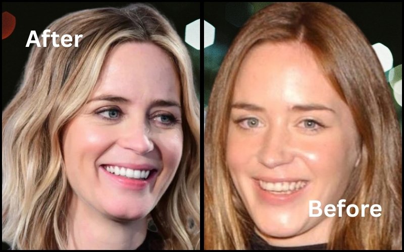 Zac Efron Veneers – Smile Transformation, Before & After